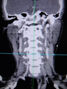 Discoplasty - Non-Invasive and Less Invasive Spine Day Procedures ...