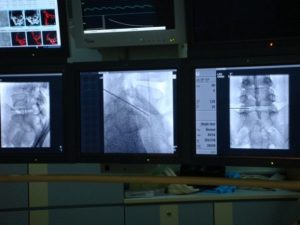 Discoplasty - Non-Invasive and Less Invasive Spine Day Procedures ...